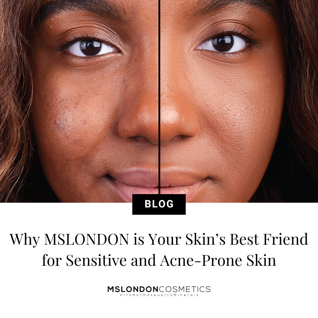 Why MSLONDON is Your Skin’s Best Friend for Sensitive and Acne-Prone S ...